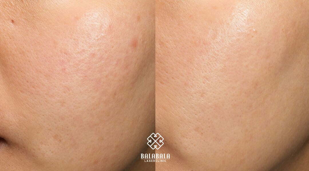 Vivace RF Microneedling | BalaBala Laser Clinic